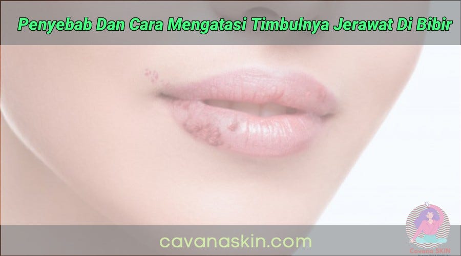 Penyebab Dan Cara Mengatasi Timbulnya Jerawat Di Bibir - Skincare ...