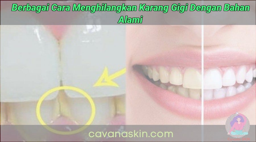 Berbagai Cara Menghilangkan Karang Gigi Dengan Bahan Alami - Skincare Terbaik - Medium