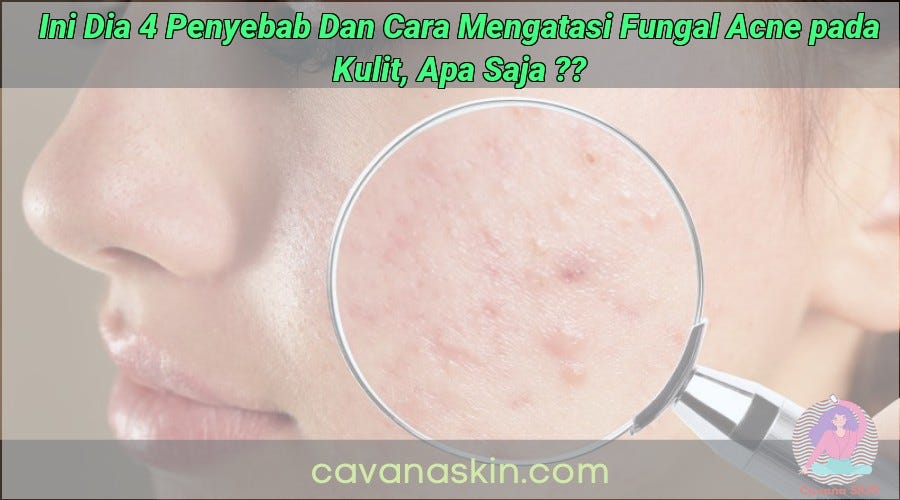 Ini Dia 4 Penyebab Dan Cara Mengatasi Fungal Acne pada Kulit, Apa Saja ...