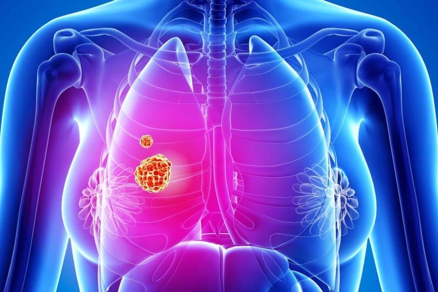 Thoracic Cancer Treatment in Pune | Dr. Lalit Banswal | by Dr. Lalit ...
