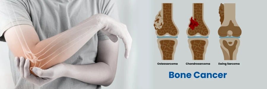 Understanding Bone Cancer: Causes, Symptoms, and Treatments | by Actioncancerhospital | May ...