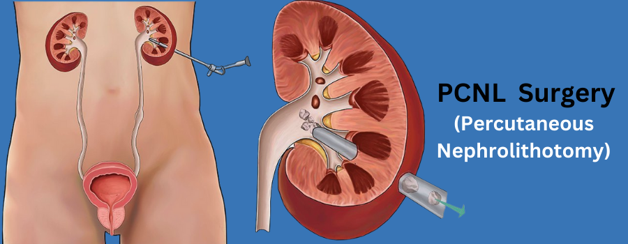 Percutaneous Nephrolithotomy: Procedure, Risks & Recovery | by Dr. Naresh Kumar Garg | Jun, 2024 ...