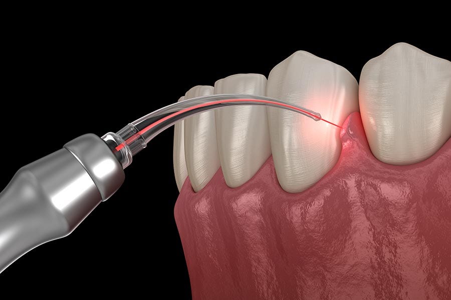 A new method of root canal treatment | by sunshineee | Medium
