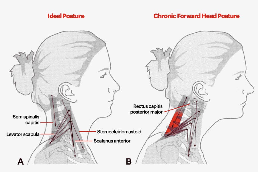 Forward Head Posture Forward Head Posture