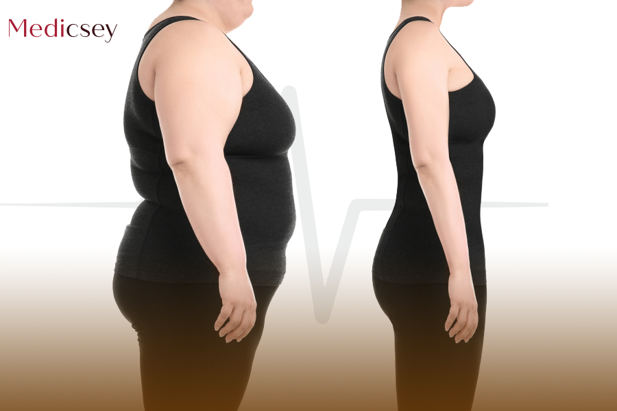 LIP. Liposuction in Turkey is one of the… | by Medicsey Turkey | Sep ...