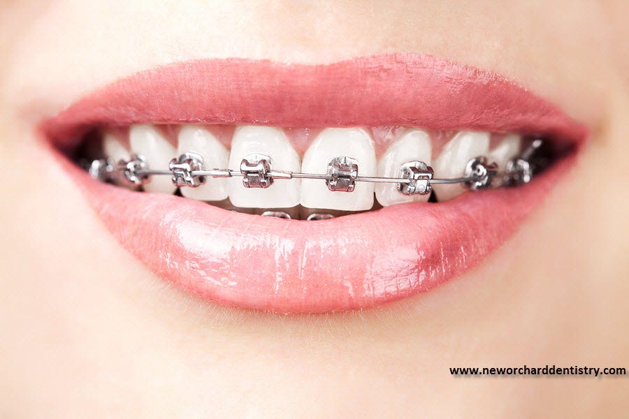 USEFULNESS OF CHOOSING HEADGEAR BRACES FOR ADULTS IN WEST BLOOMFIELD ...