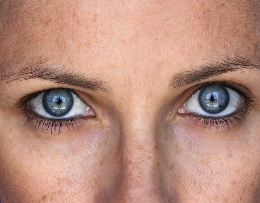 Melasma: The Pregnancy Mask. Along with the many changes a woman’s ...