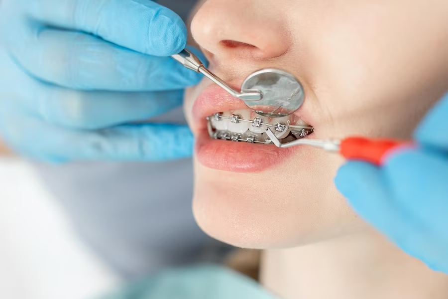 Braces Tightening: How long can you go without having to adjust your ...