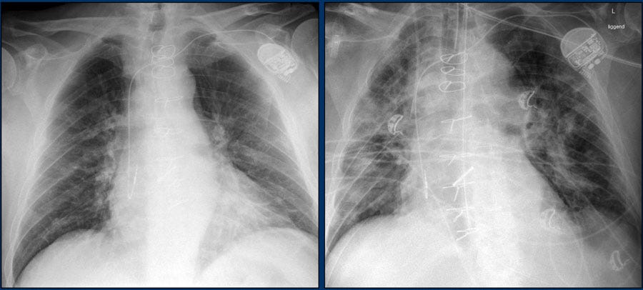 Covid 19 Chest X Ray Classification using Transfer Learning and KNN ...