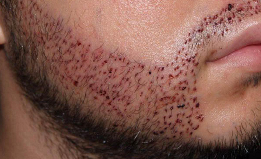 Regal Beards Riyadh’s Premier Beard Hair Transplant Sanctuary | by ...