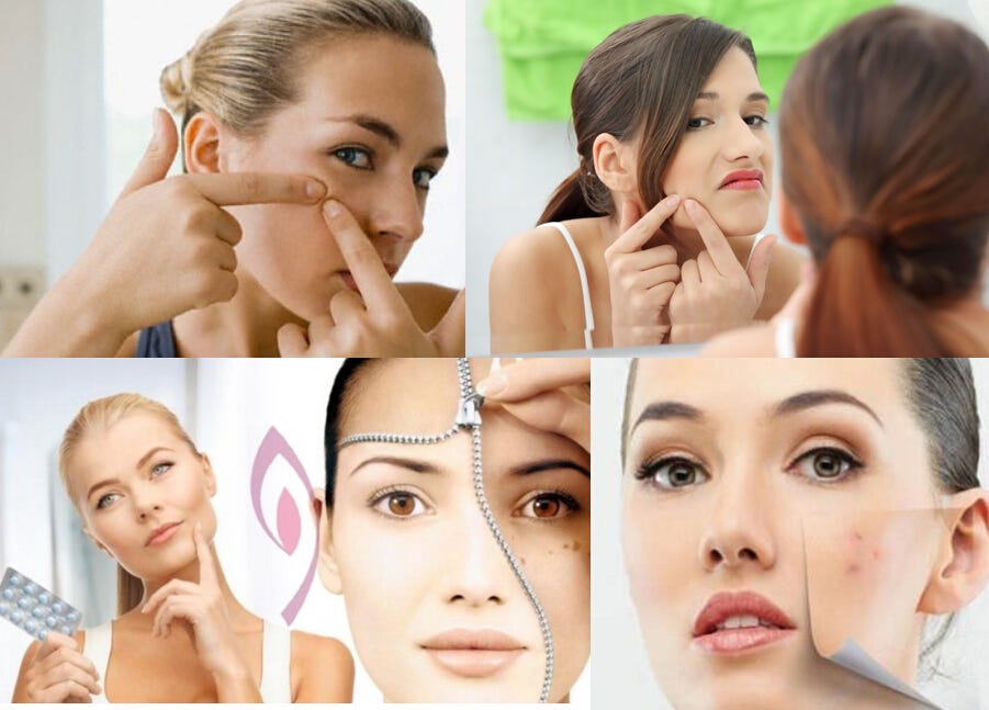 3 Best Ways To Get Rid Of Pimples Overnight | by Alessia johnson | Medium