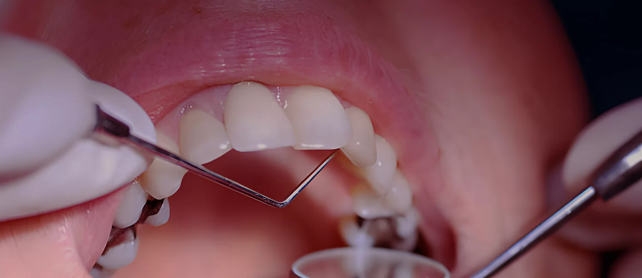 The Visual Guide to Identifying Cavities: What does a cavity look like ...
