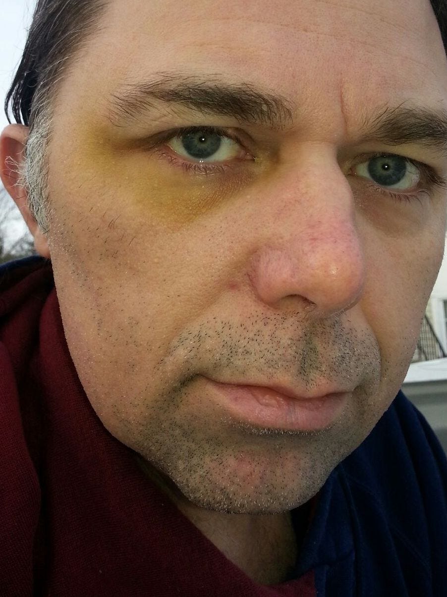 Becoming Bionic — Day 7. Cochlear implant update — 2015/02/24 | by The ...