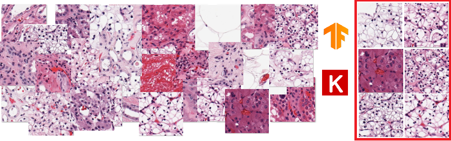Multiple instance learning (MIL) , using Keras, with clear cell renal ...