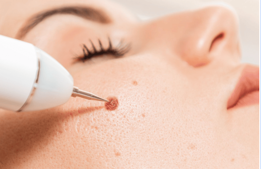 Unlocking Mole Removal: Your Complete Guide! | Medium