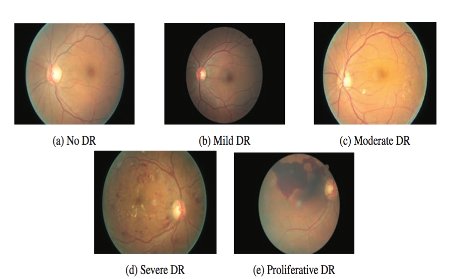 Data Preprocessing and Workflow on Fundus Images for Classification of ...