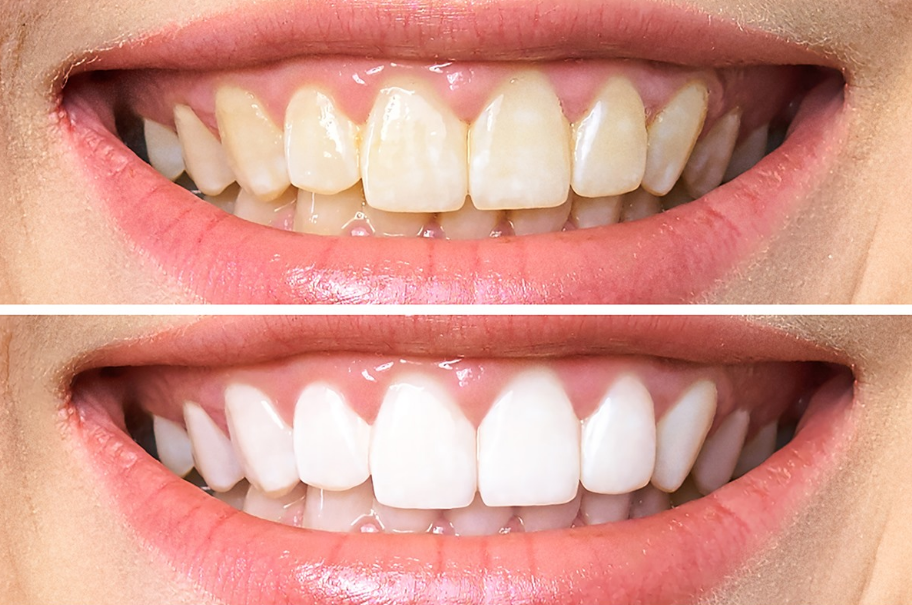 Look Your Best with Teeth Whitening Strips | by Malvern Smile Studio ...