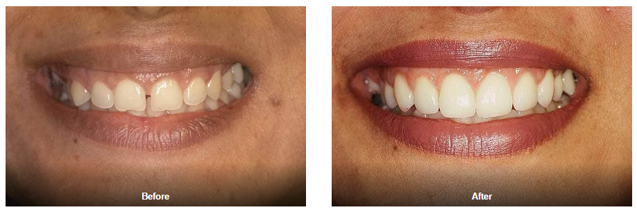 Gap Closure Treatment for Teeth — Smilesforever Dental Clinic | by ...
