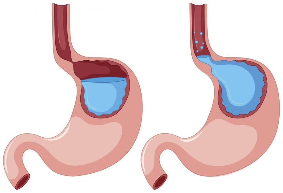 What is Gastroesophageal Reflux Syndrome (GERD)? | by Globus Hospital ...