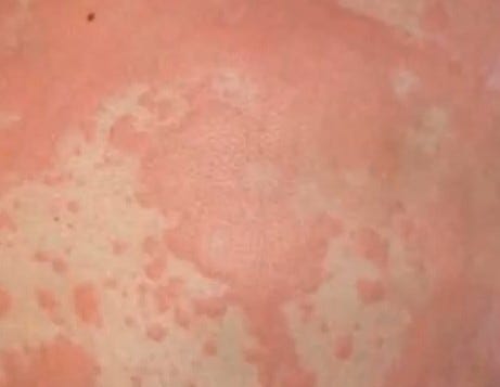 Acute Hiv Rash Chest
