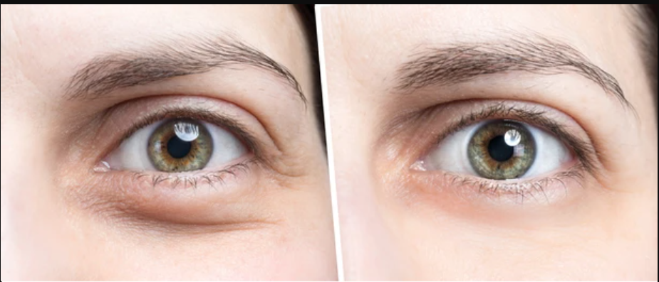 How do under eye bags form ?. Introduction | by TimriCosmetics | Medium
