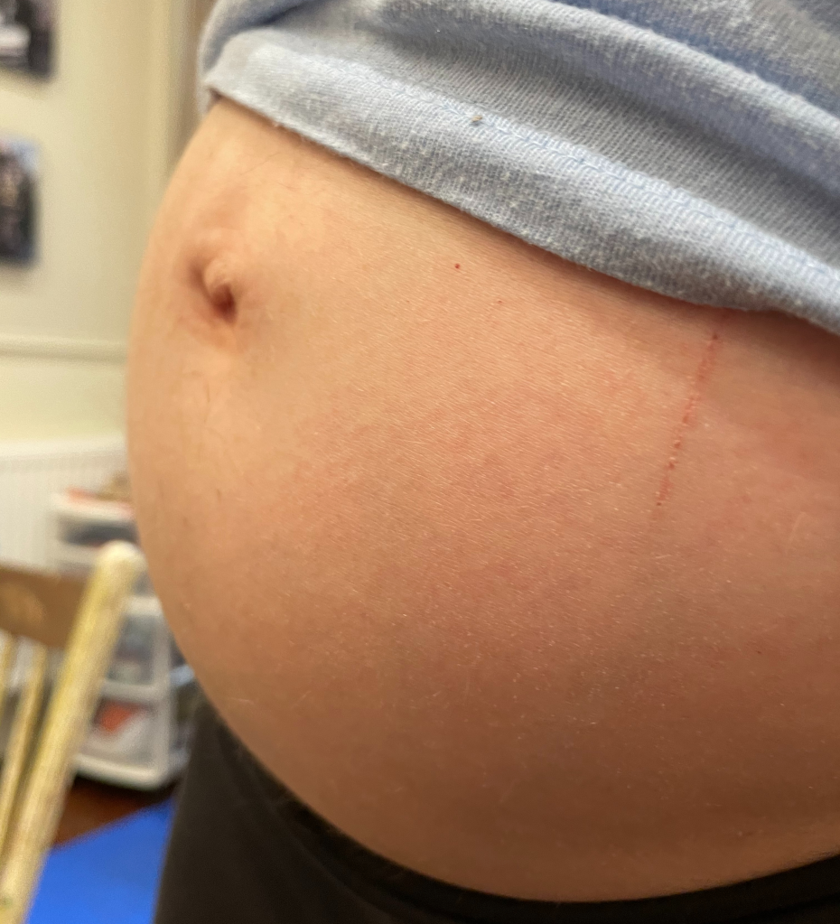 Why the Gym Won’t Cure a (Post-Baby) Jelly Belly | by Robin S | Medium