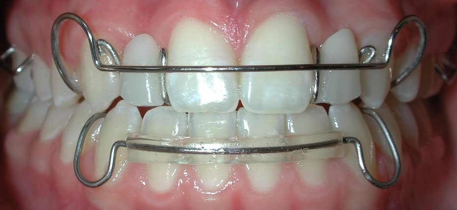 Maintain Your Dental Victory: Understanding Hawley Retainers | by Vida ...