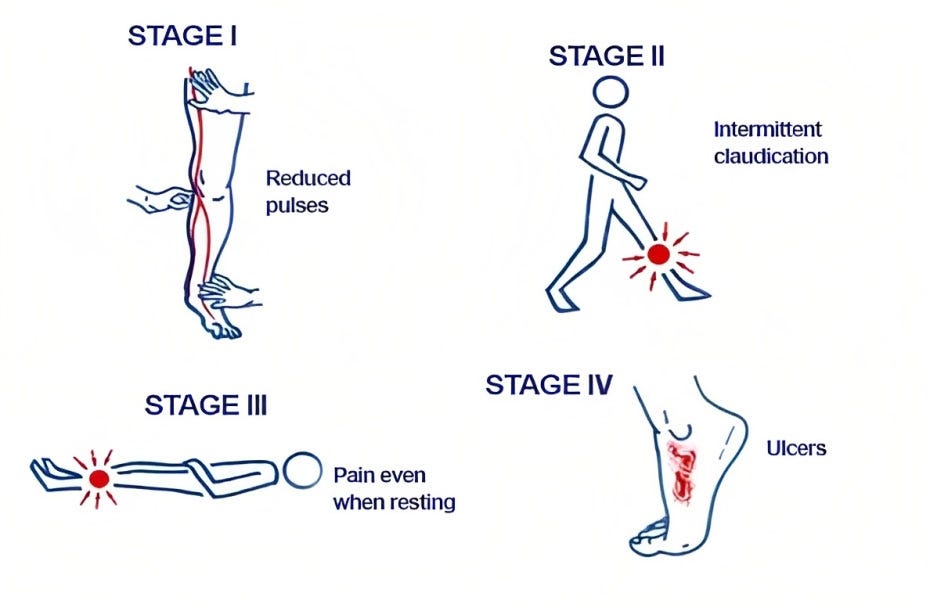 What are the stages of peripheral vascular disease? | by Dr Kunal Arora ...