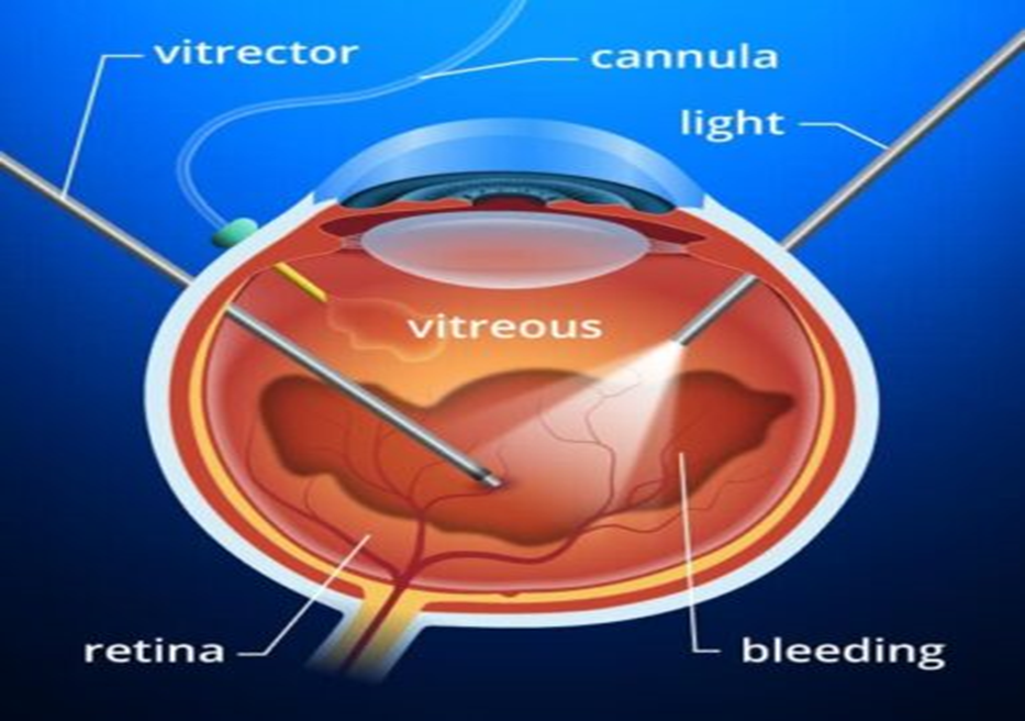 Best Retina Specialist in Ghaziabad — Vedanta Netralya | by Vedanta Netralya | Mar, 2024 | Medium