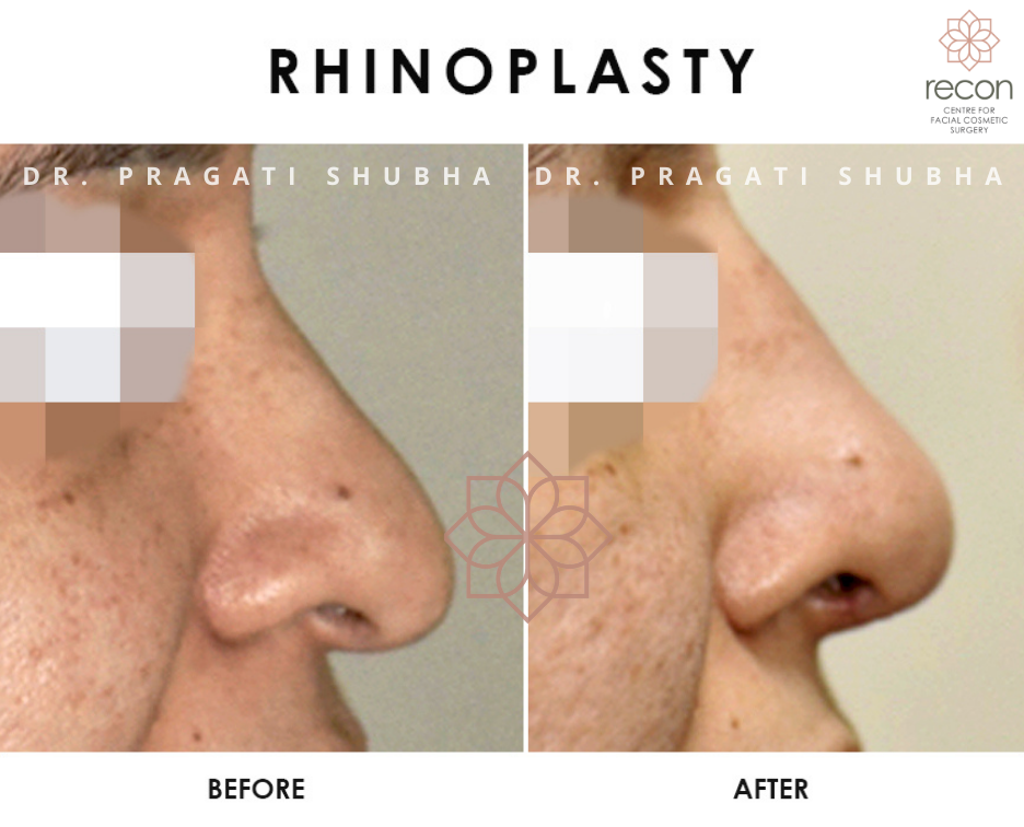 Rhinoplasty in Gurgaon | Rhinoplasty Surgery in Gurgaon | RECON ...