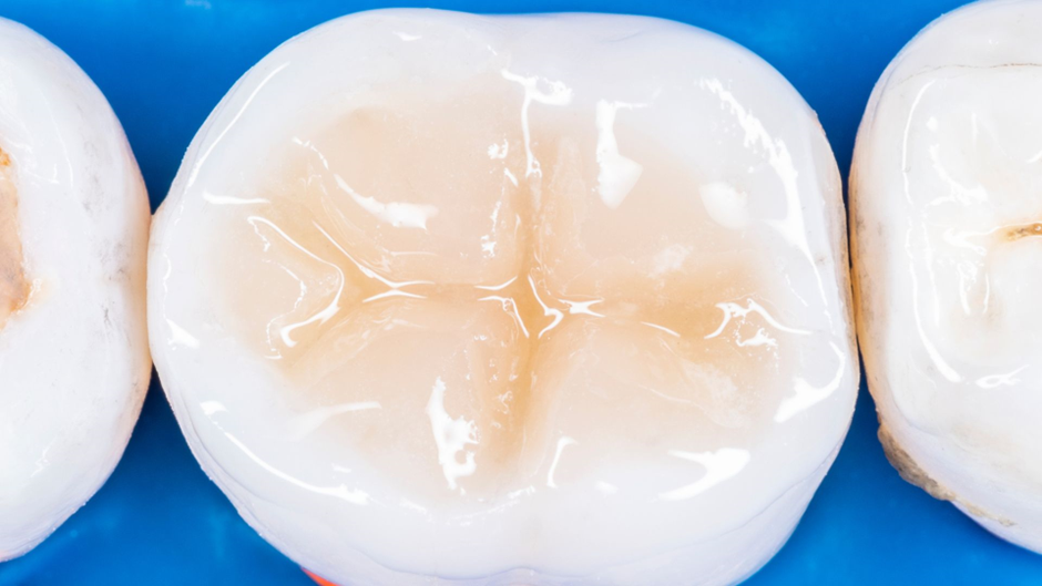 7 Tips for Taking Care of Your Tooth Fillings | by Eliasediaz Official ...