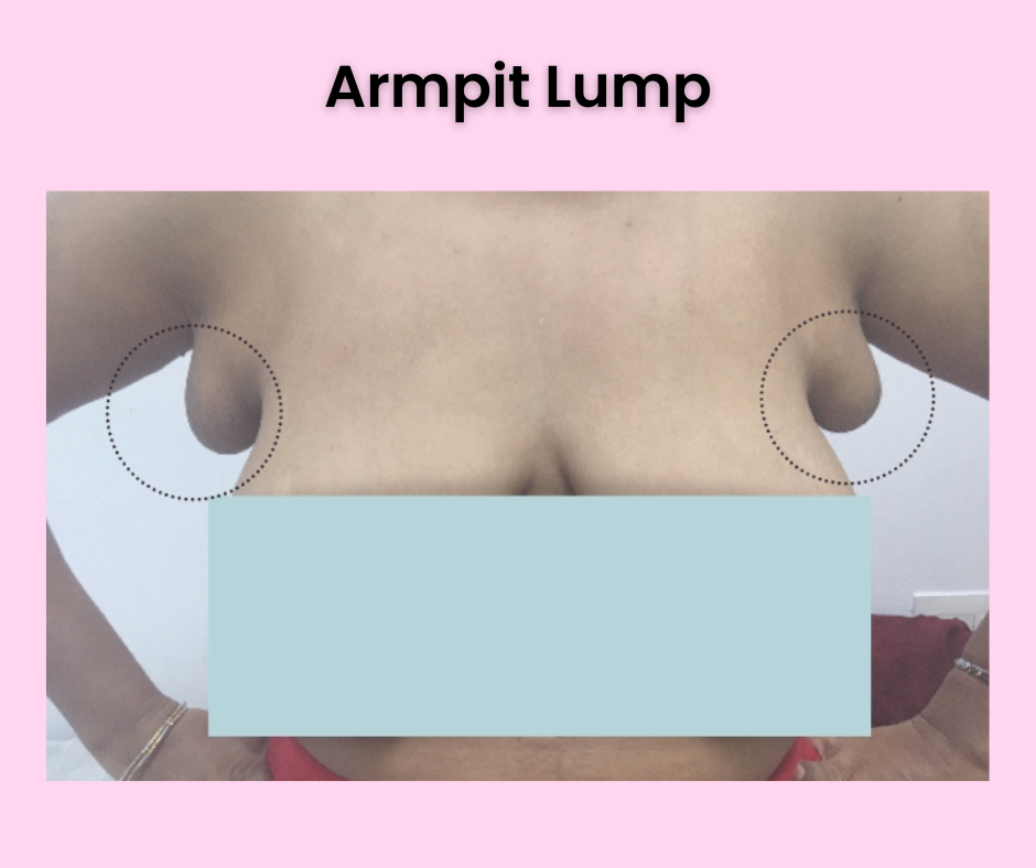 Effective Armpit Lump Treatment In Pune Expert Care Available Doctorsinpunee Medium