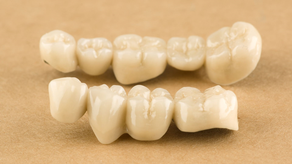 The Benefits of Dental Bridges for Replacing Front Teeth | by ...