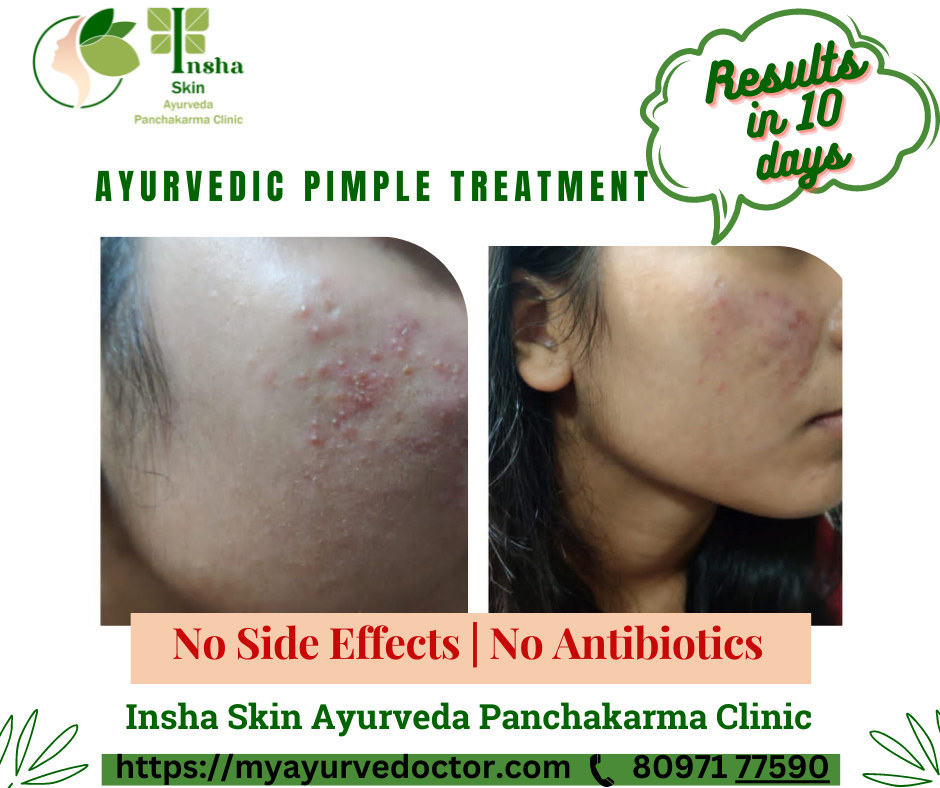 𝗖𝗵𝗲𝗰𝗸 𝗼𝘂𝘁 𝗮𝗺𝗮𝘇𝗶𝗻𝗴 𝗥𝗲𝘀𝘂𝗹𝘁𝘀 𝗔𝗳𝘁𝗲𝗿 𝗔𝗰𝗻𝗲 𝗧𝗿𝗲𝗮𝘁𝗺𝗲𝗻𝘁 - Insha Skin Ayurveda ...