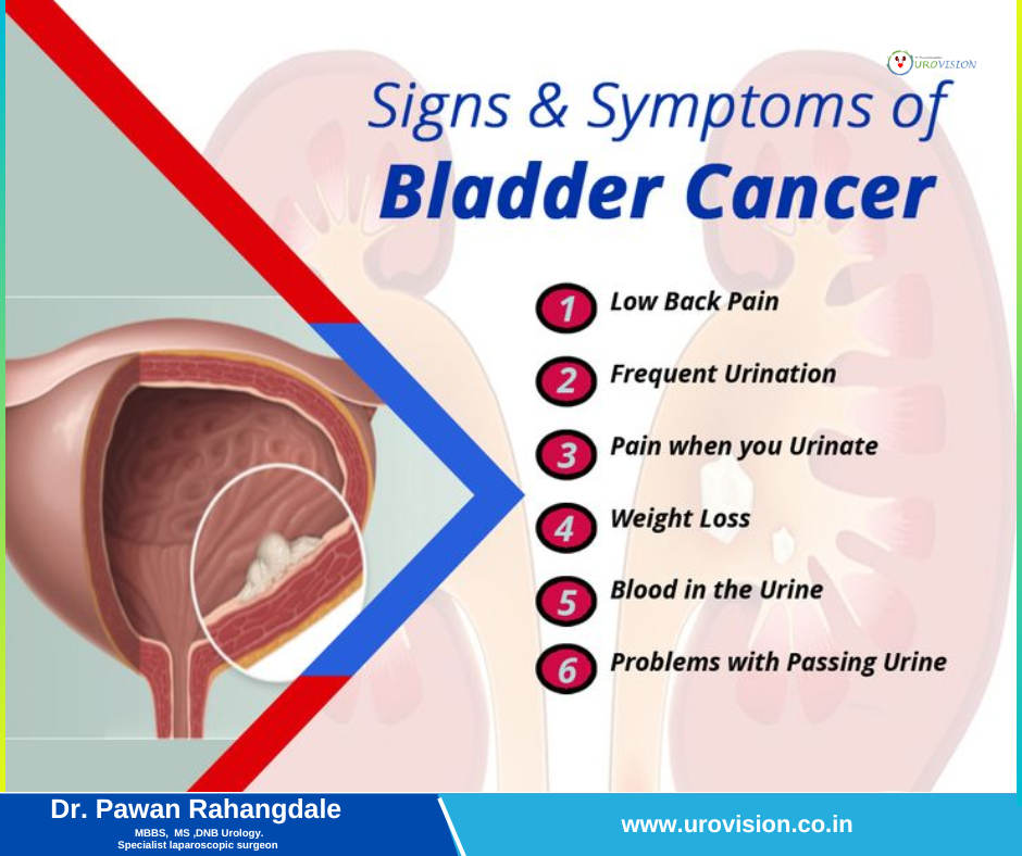 Bladder Cancer: Signs, Symptoms, and What You Should Know | by ...