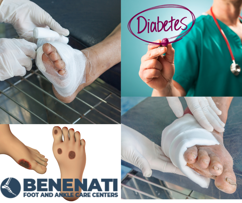 Diabetes and Ulcerated Feet. Have you been diagnosed with diabetes ...