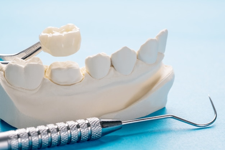 4 Tips for Longevity and Maintenance of Dental Crown | by Fielding ...