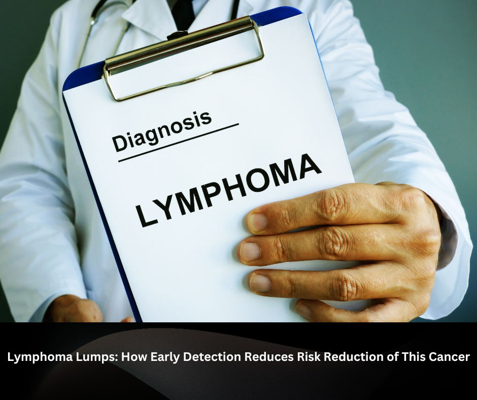 Lymphoma Lumps How Early Detection Reduces Risk Reduction Of This Cancer By Stephen Miller