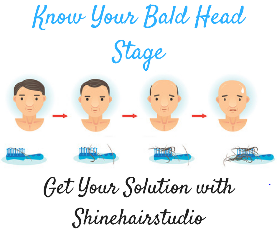 Bald Head. #HairReplacement, #HairExtensions… | by Shine Hair Studio ...