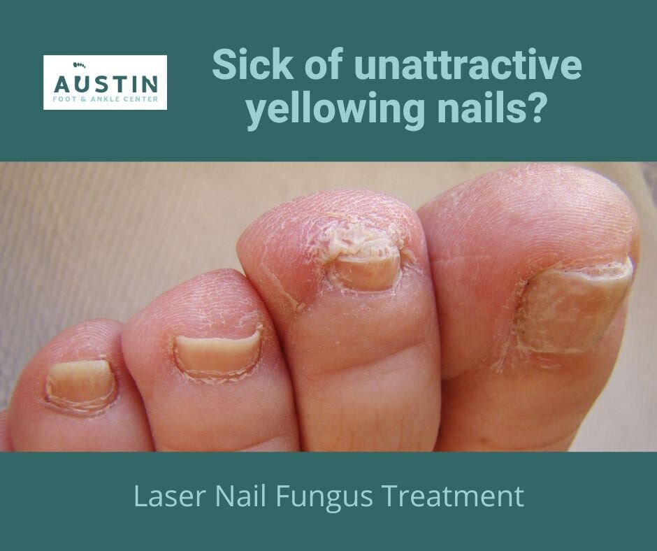 Effective Nail Fungus Treatment In Austin Podiatristaustin Medium