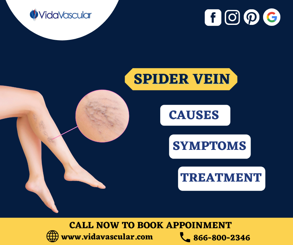 SPIDER VEINS SYMPTOMS, CAUSES, AND TREATMENT | by Vida Vascular | Medium