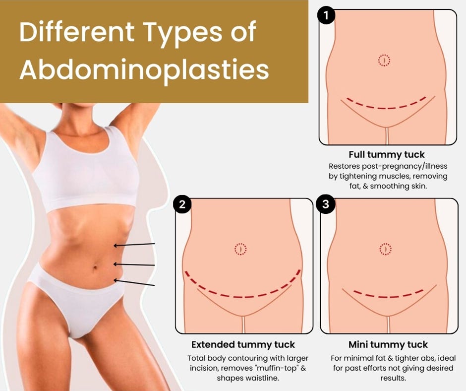 4 Types of Tummy Tuck Procedures You Might Not Know About | by Millennial Plastic Surgery | Feb ...