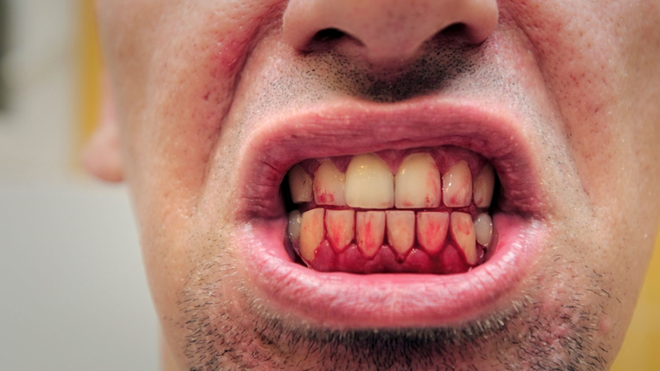 How to Stop Gum Bleeding?. If you’re suffering from gum bleeding… | by ...