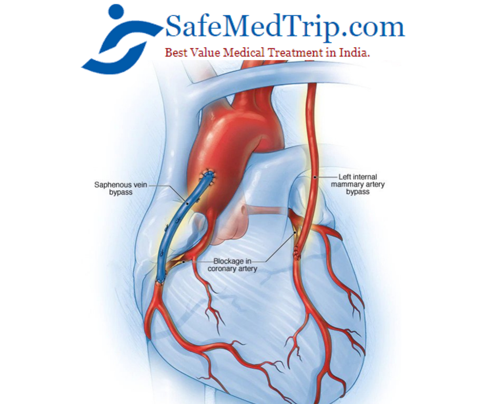 Heart Bypass Surgery in India | Coronary Bypass Surgery in India | by ...