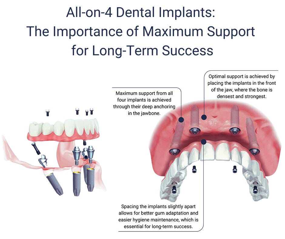 All-on-4 Dental Implants in New York City | by NYC Dental Implants Center | Medium