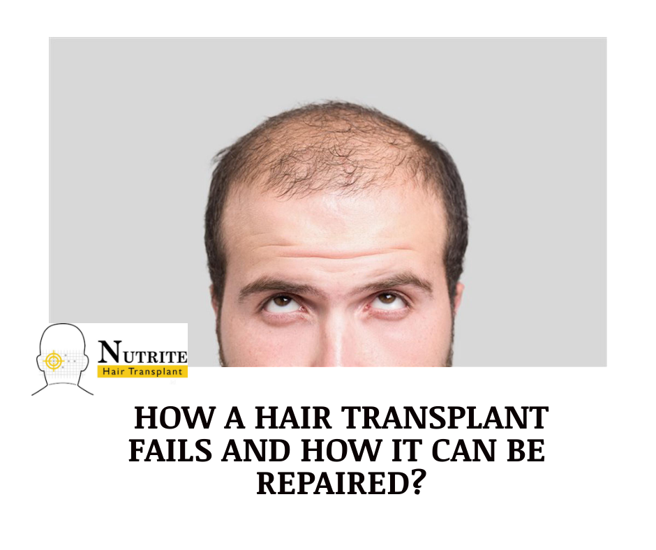 How a Hair Transplant Fails and how it can be Repaired? | by Nutrite ...