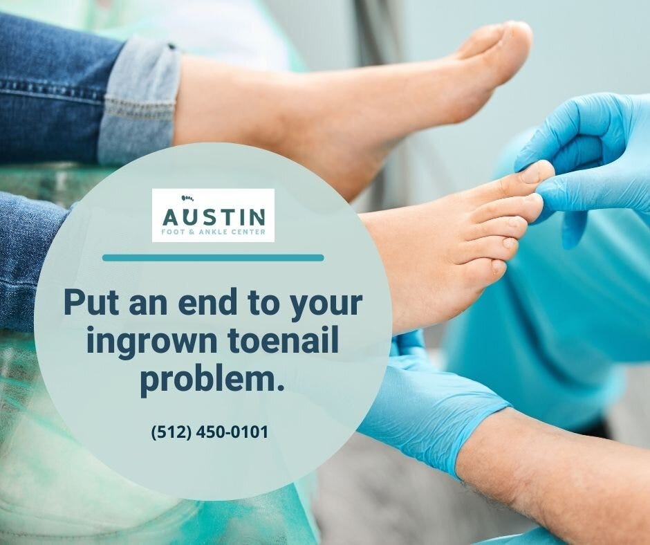 Austin ingrown toenail treatment - PodiatristAustin - Medium