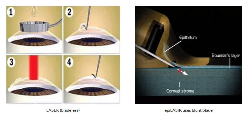 Lasik Surgery in Singapore — Dr Natasha Lim - drnatasha lim - Medium