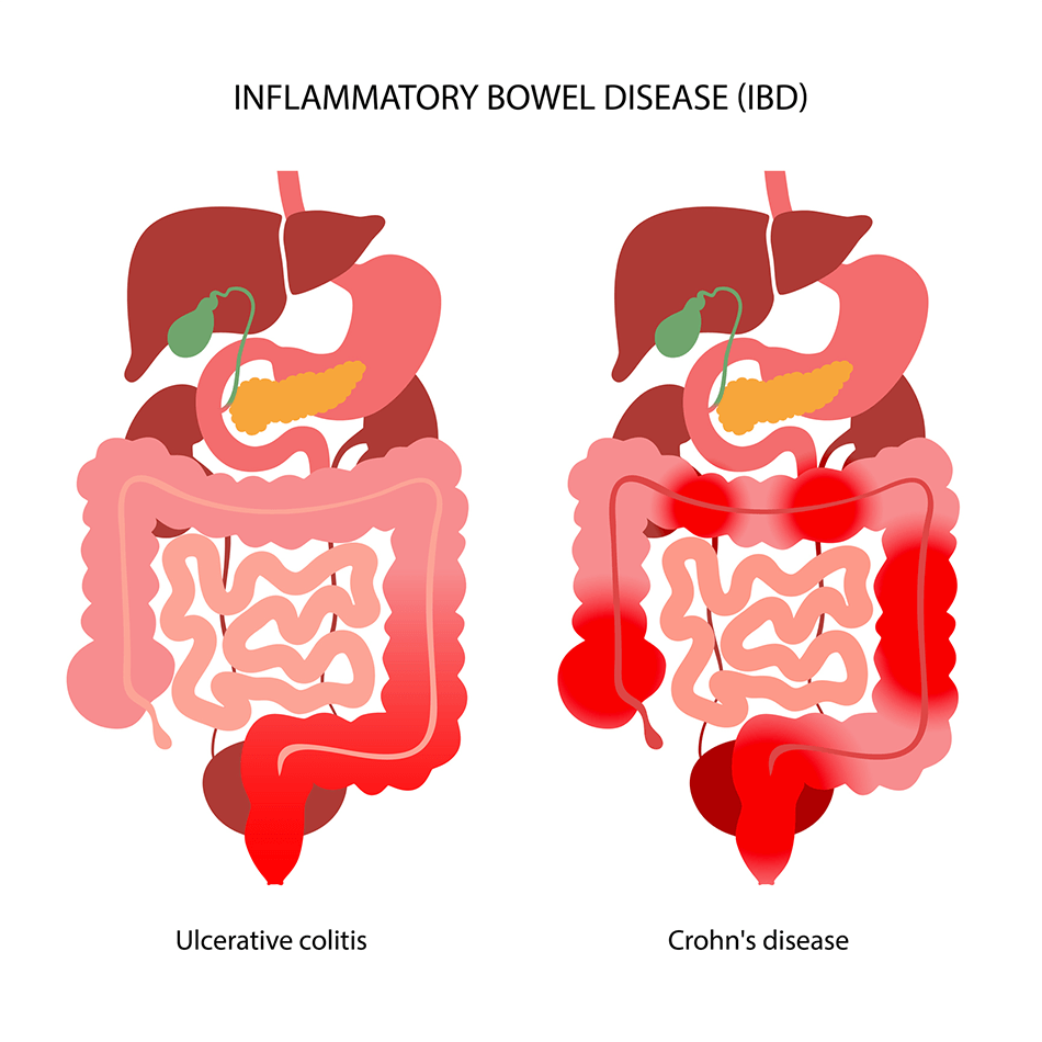 Inflammatory Bowel Disease (IBD): A Complex Spectrum of Chronic ...