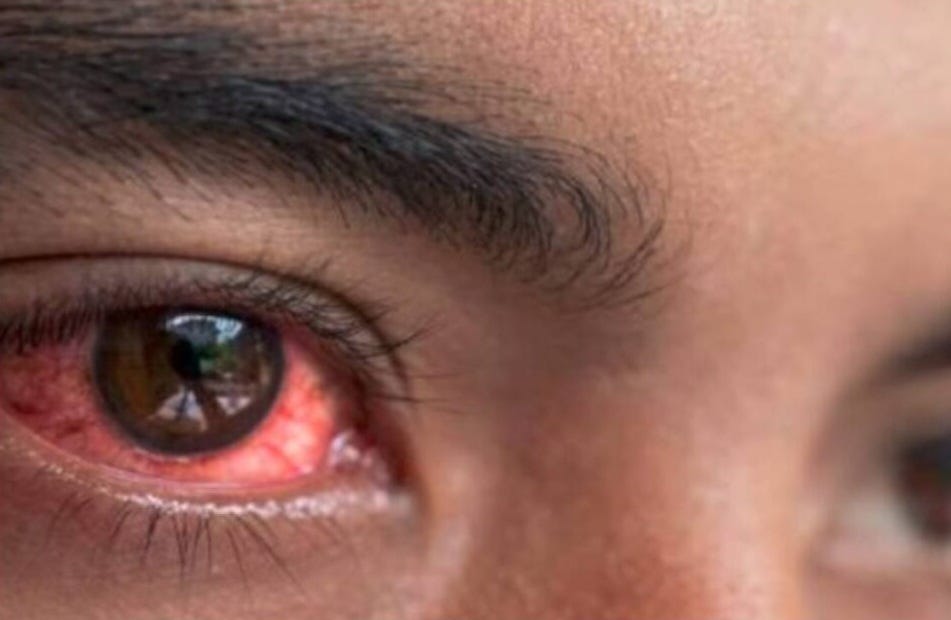 Pink eye virus (conjunctivitis) As you are aware, the current rapid ...